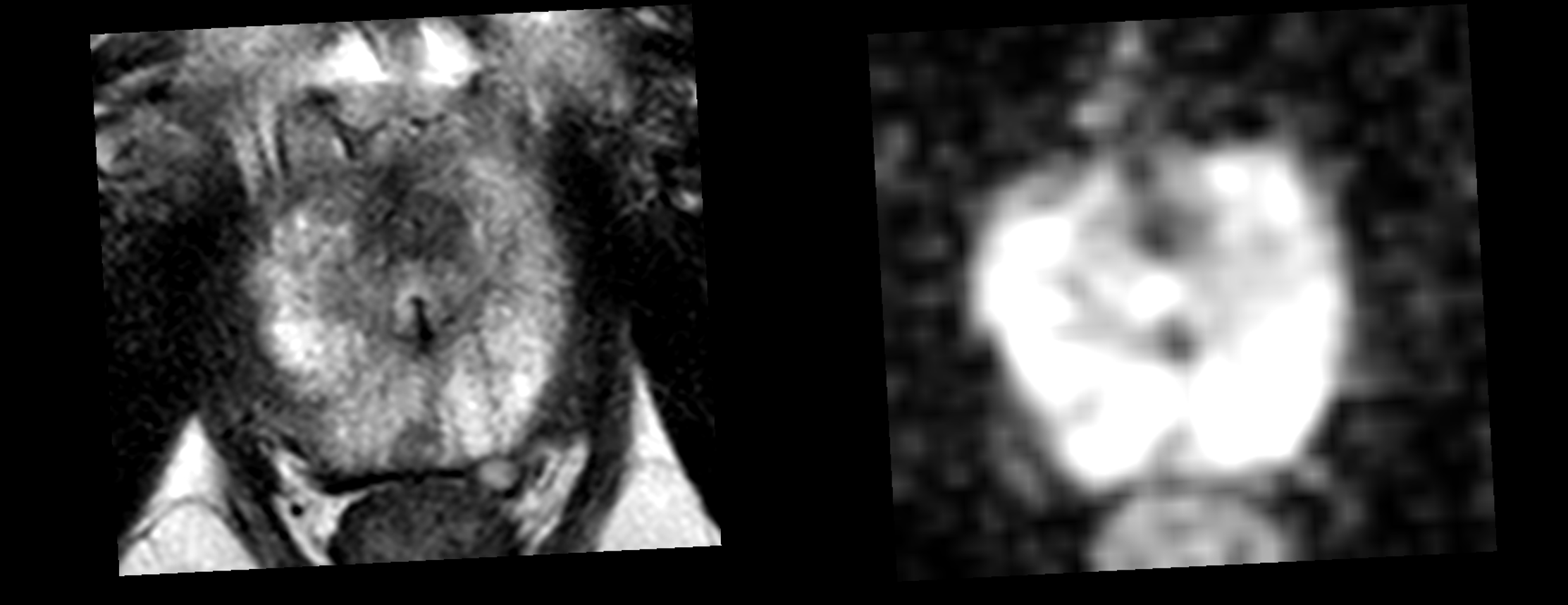 MRI-Based Surrogate Imaging Markers of Aggressiveness in Prostate ...
